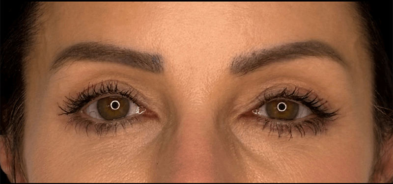 Blepharoplasty Before and After - Designer Plastic Surgery Aesthetics ...