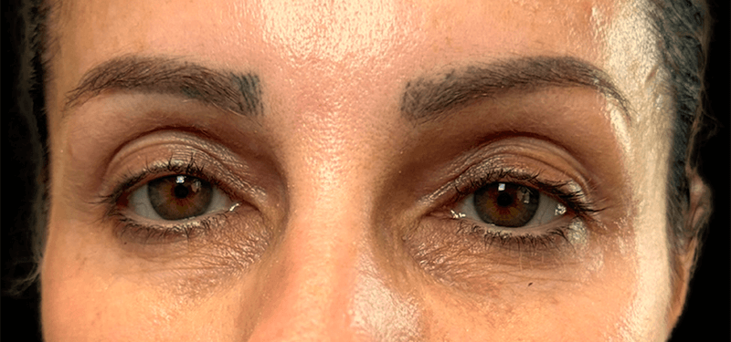 Blepharoplasty Before and After - Designer Plastic Surgery Aesthetics ...